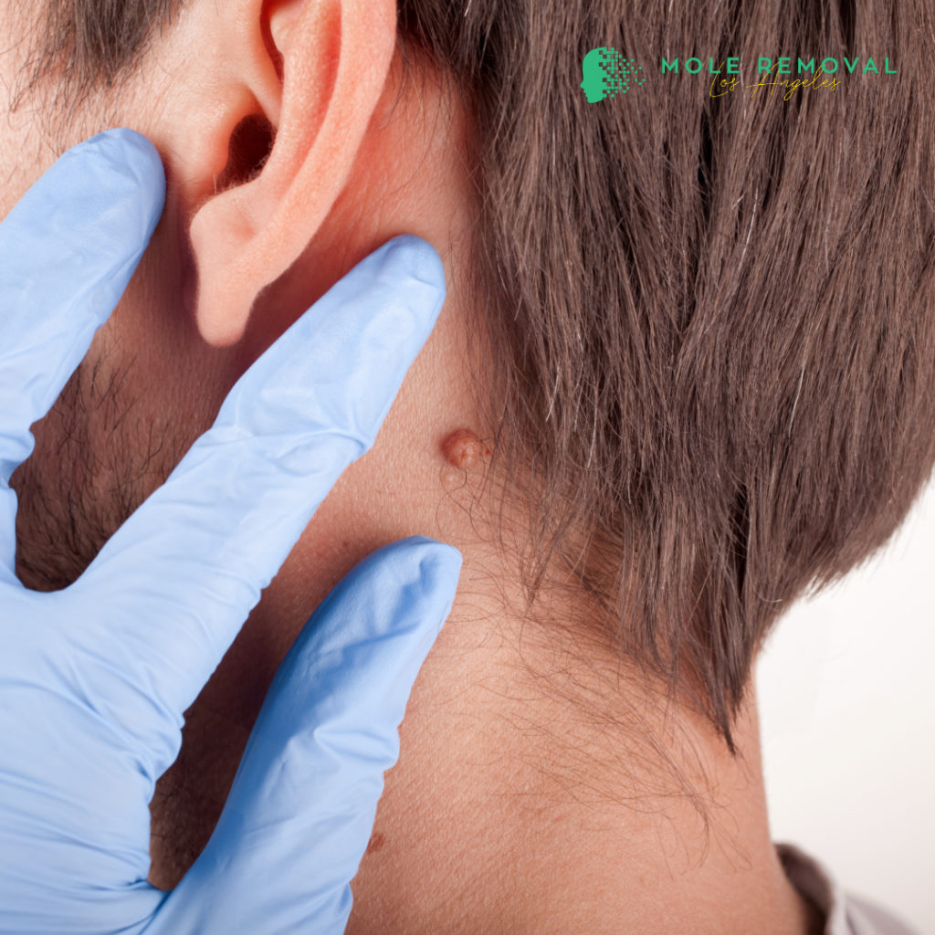 Expert Mole Removal Beverly Hills | Laser Mole Removal