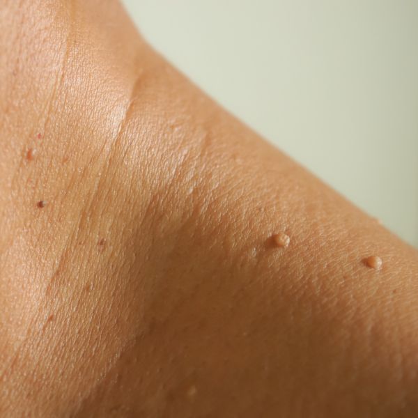 Learn About Removing Skin Tags On Neck | Neck Skin Tag Removal