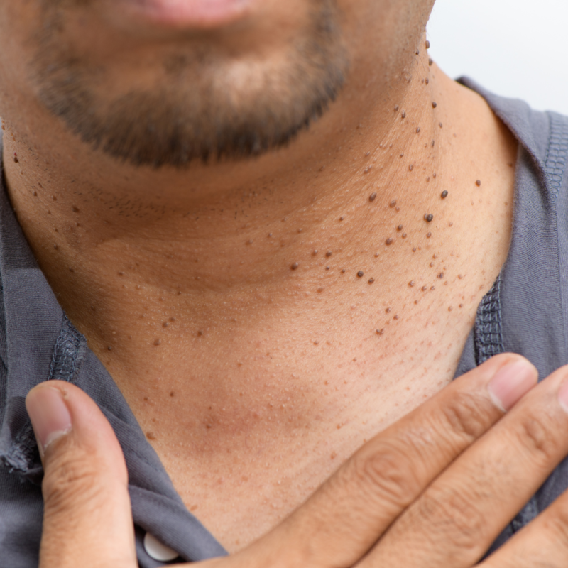 Painless Skin Tag Removal Los Angeles | Remove Unsightly Skin Tags